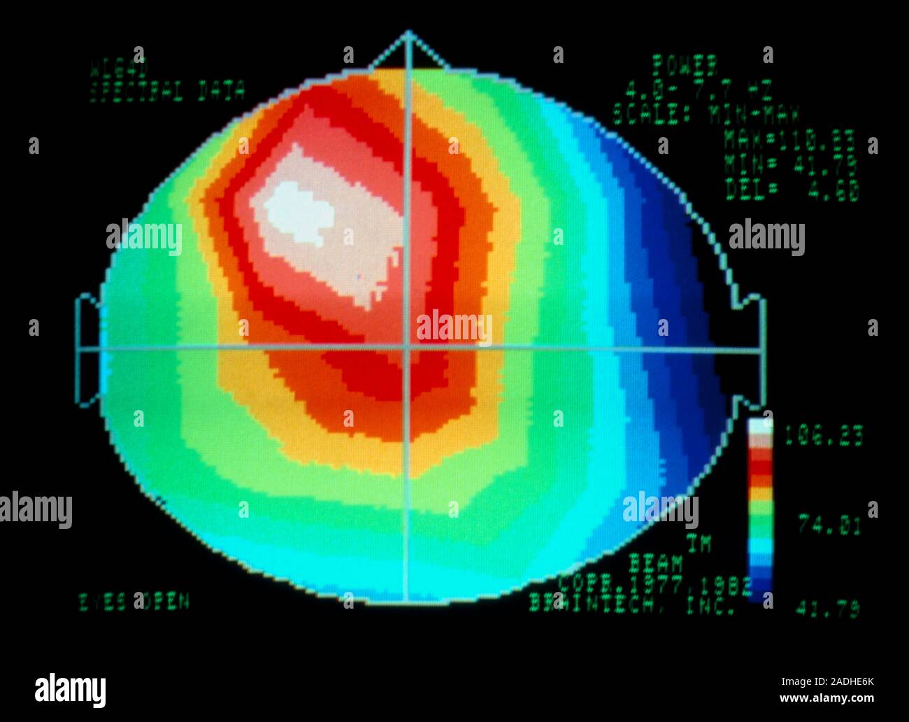Image of the brain of a dyslexic boy produced by brain electrical activity mapping (BEAM). The ...