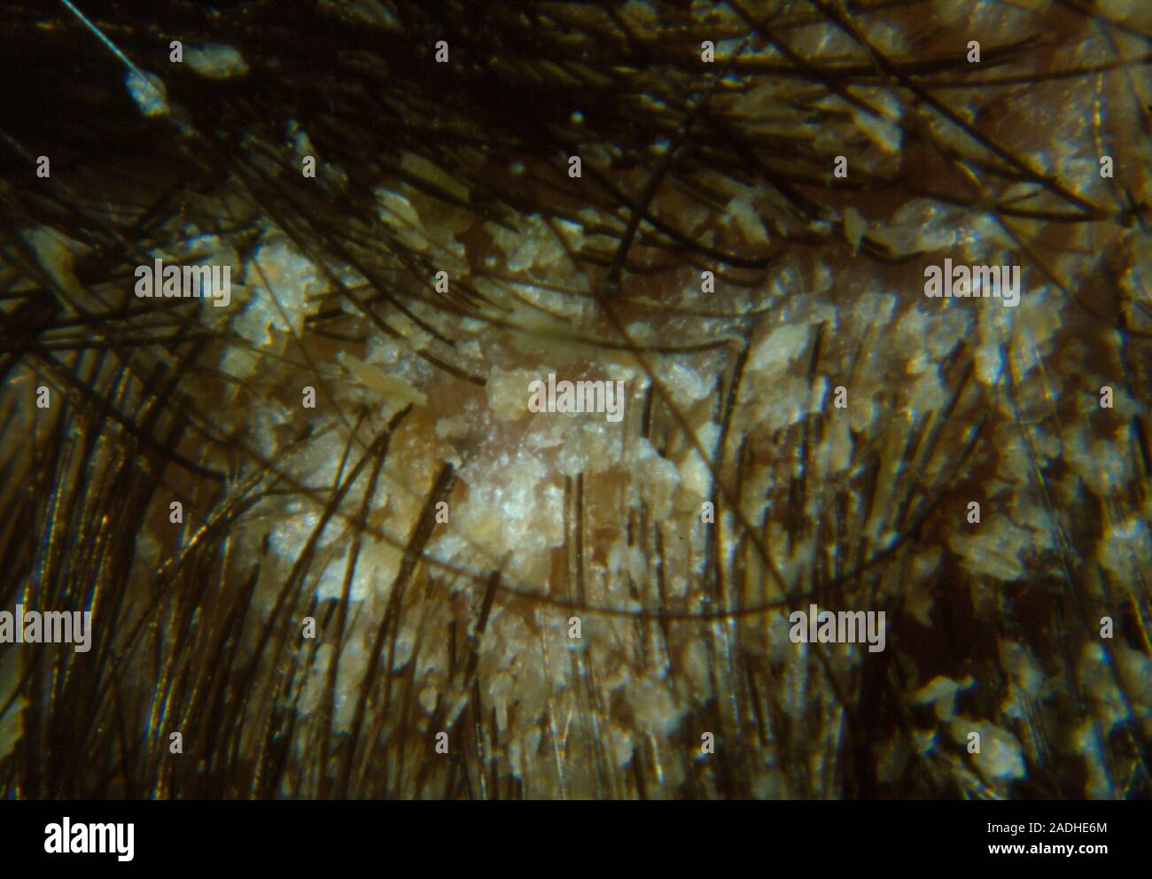 Close-up view of the human scalp in a case of severe dandruff ...