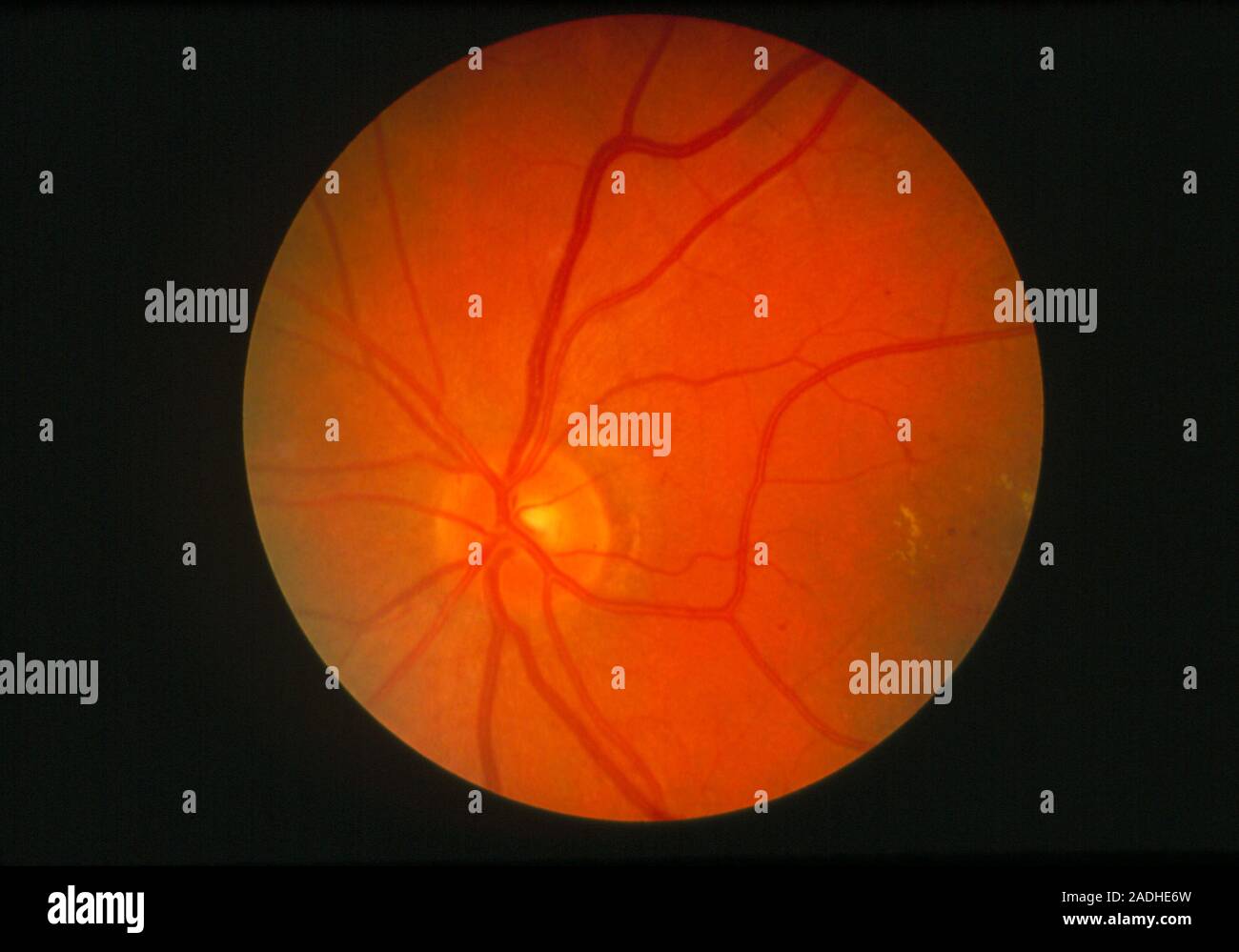 Diabetic retinopathy: fundus camera image of the retina of the eye in a ...