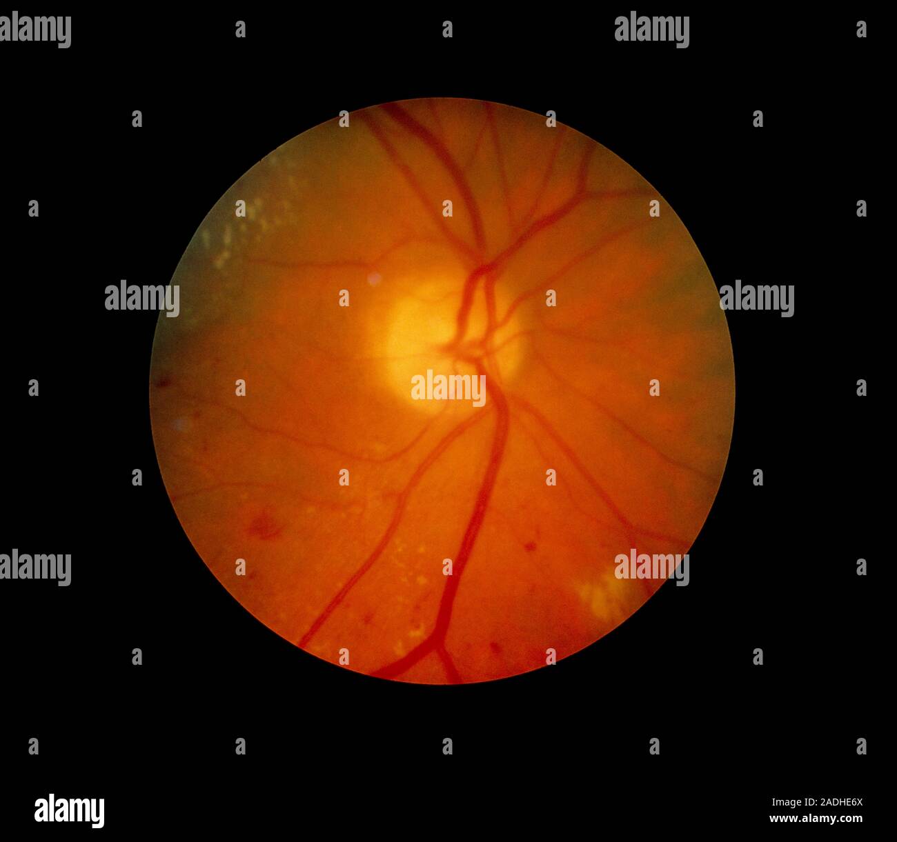 Diabetic retinopathy: fundus camera image of the retina of the eye in a ...
