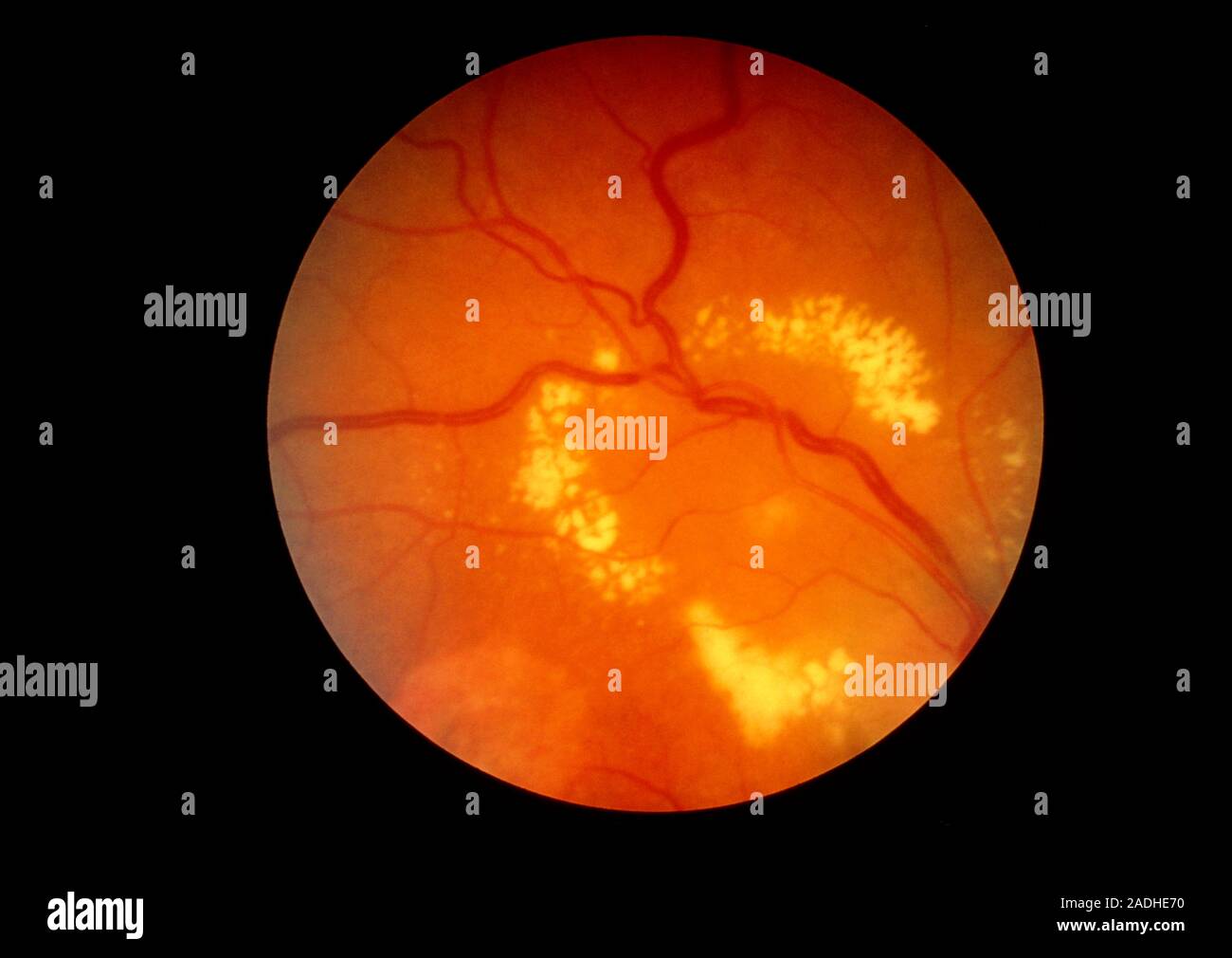 Diabetic retinopathy: fundus camera image of the retina of the eye in a ...