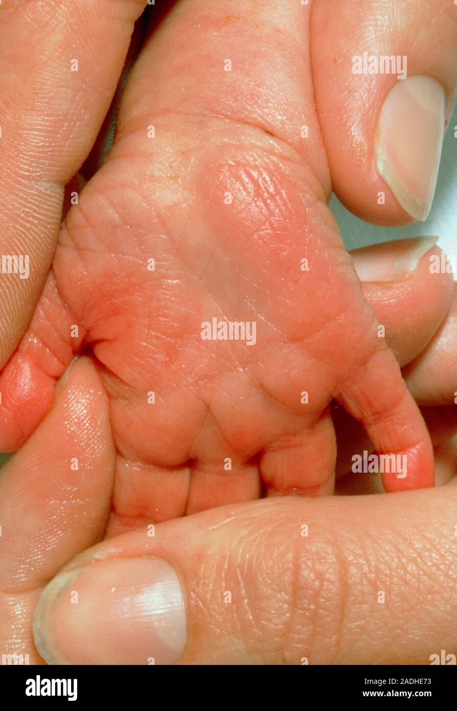 Down's Syndrome hand. Palm of the hand of a Down's syndrome infant ...