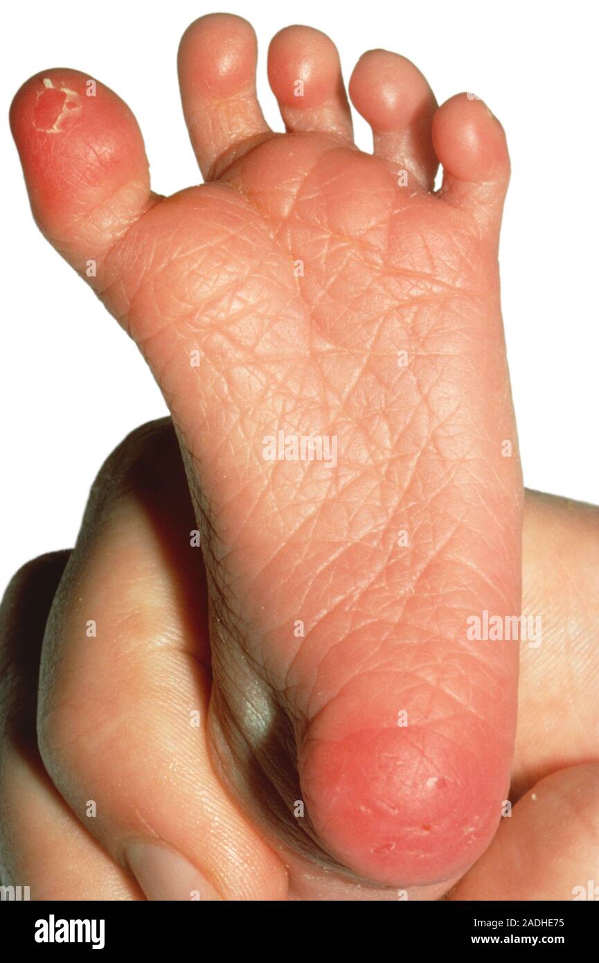 Down's Syndrome foot. Sole of the foot of a Down's syndrome infant ...