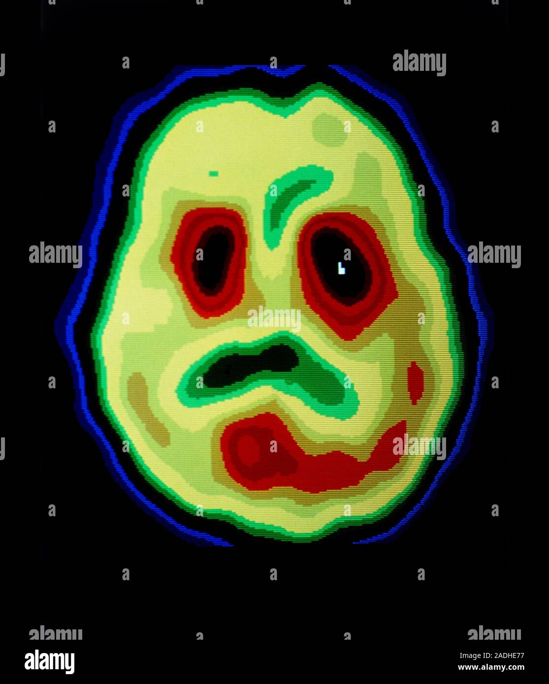 Positron emission tomography (PET) scan of the brain of a person ...