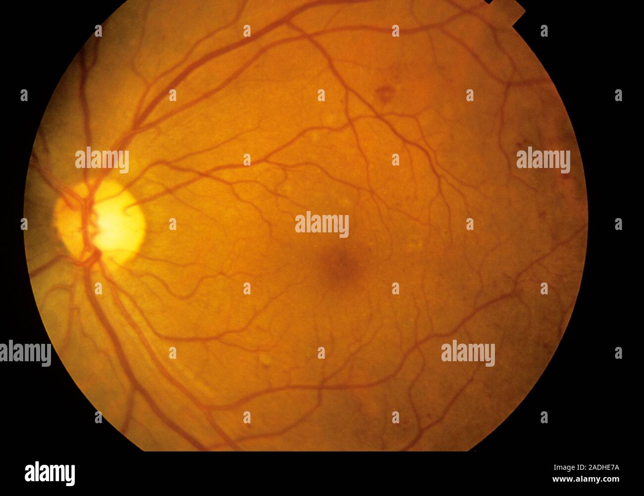 Diabetic retinopathy: fundus camera image showing the blood vessels of ...