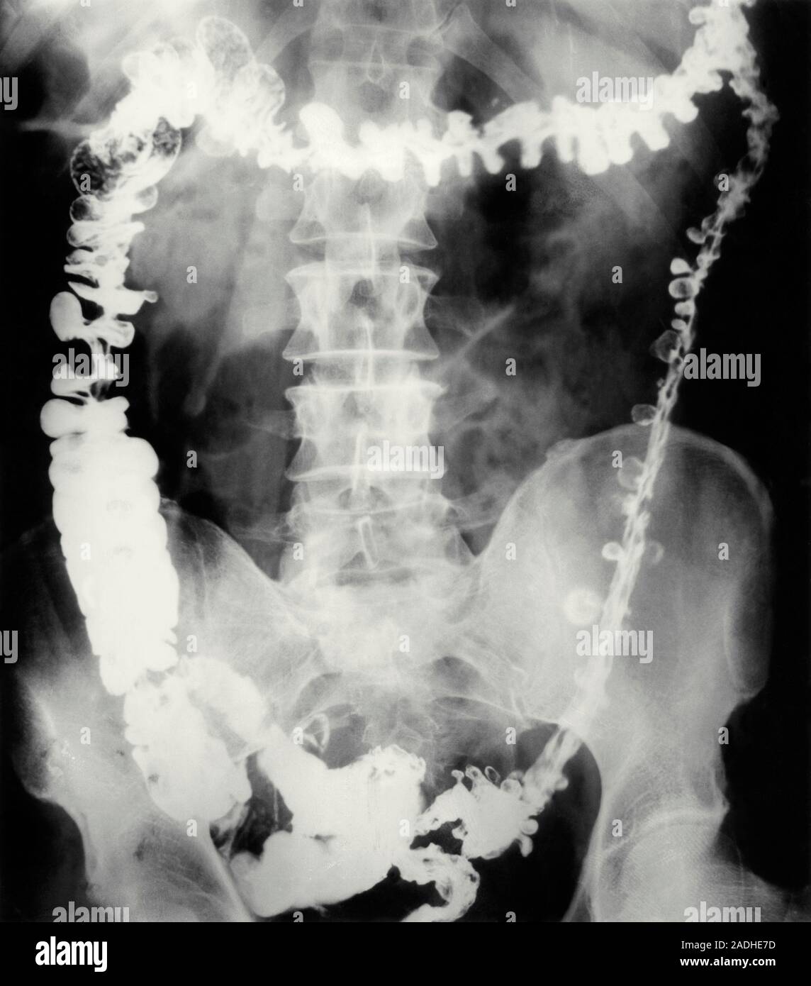 Colonic diverticular disease: barium contrast X- ray showing numerous ...