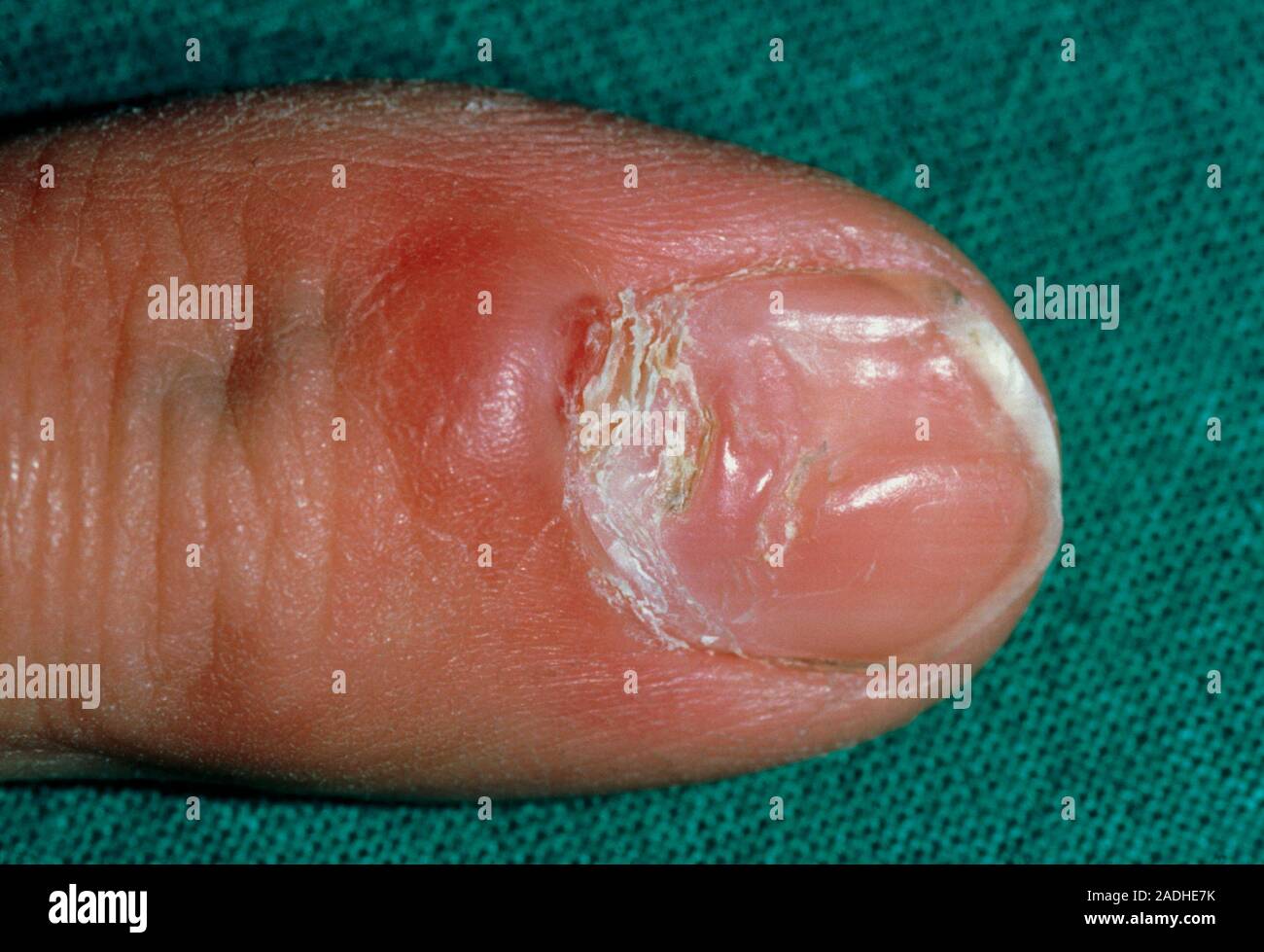 Dystrophic fingernail. Dystrophy of an organ or tissue is a disorder ...