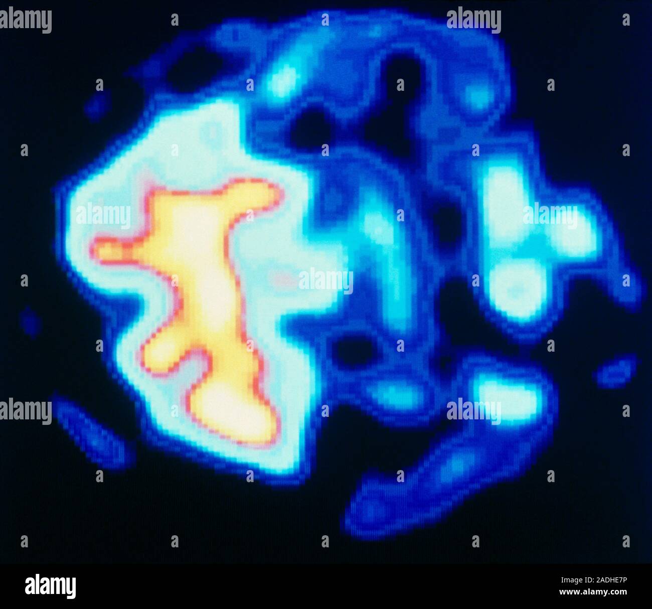 Positron emission tomography (PET) scan of the brain (cerebellum level ...