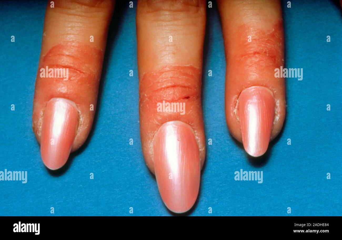 Contact (skin) dermatitis, a form of eczematous dermatitis, the cause ...