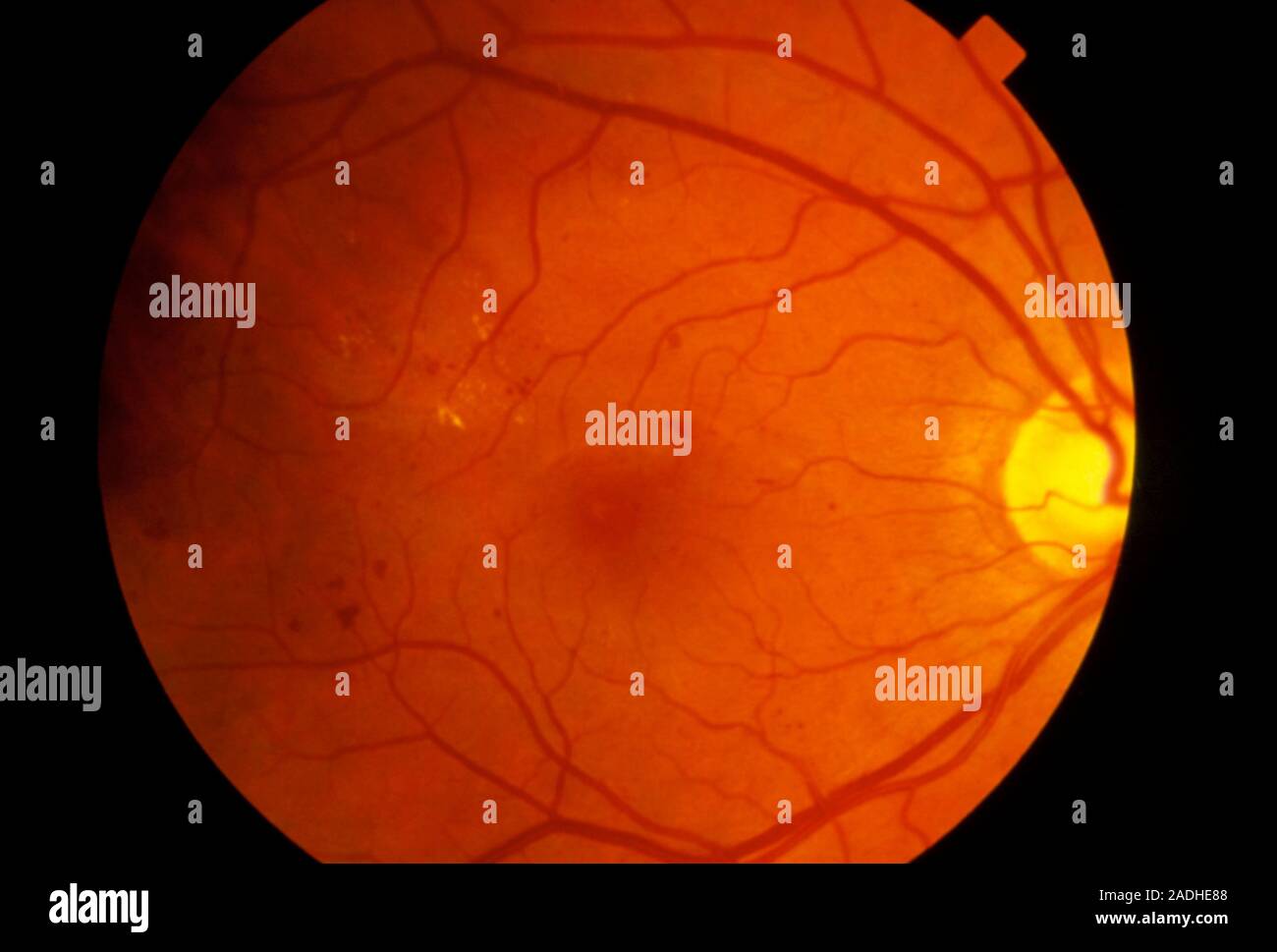 Diabetic retinopathy: fundus camera image of the retina of a human eye ...