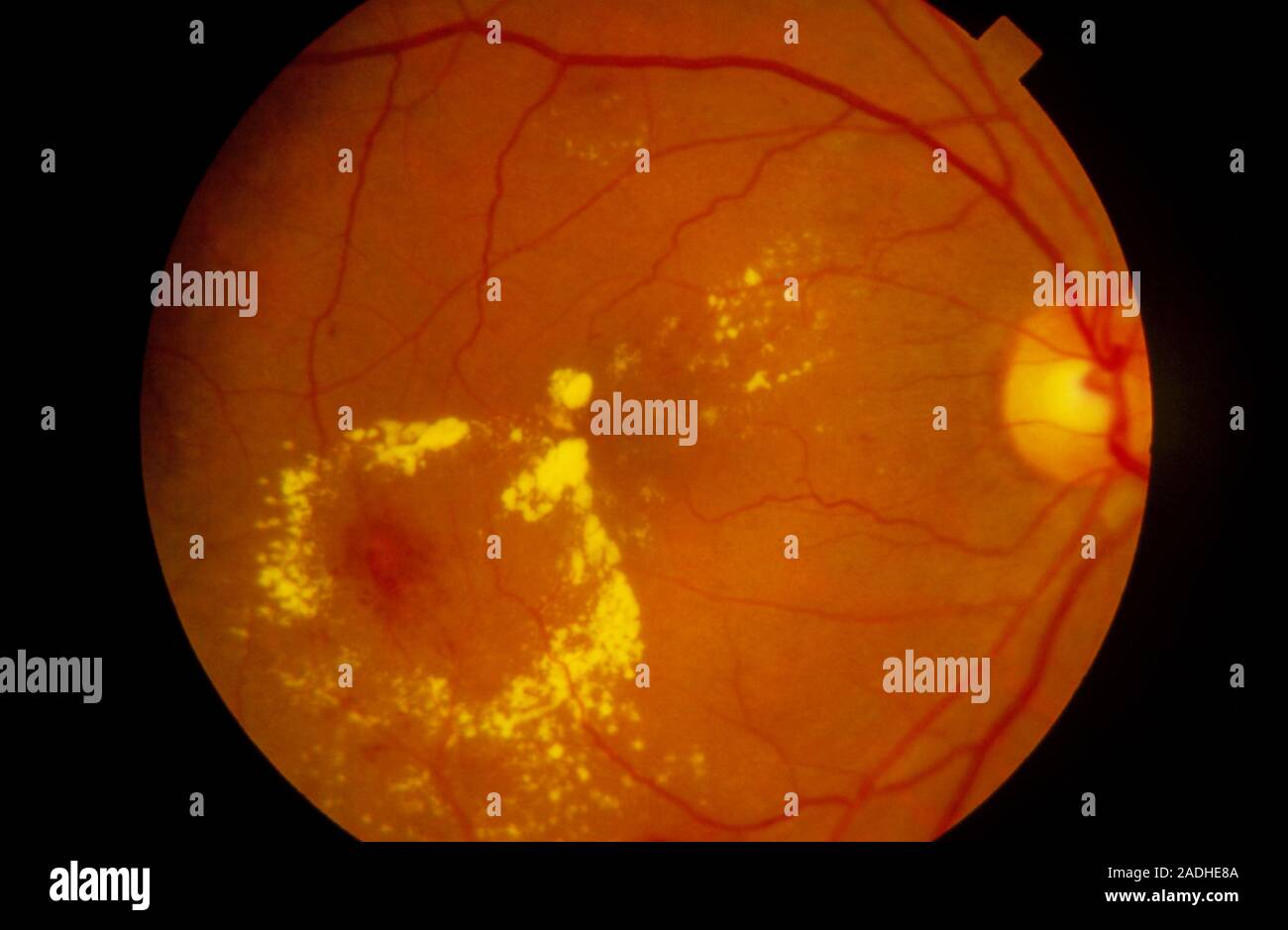 Diabetic retinopathy: fundus camera image of the retina of a human eye ...