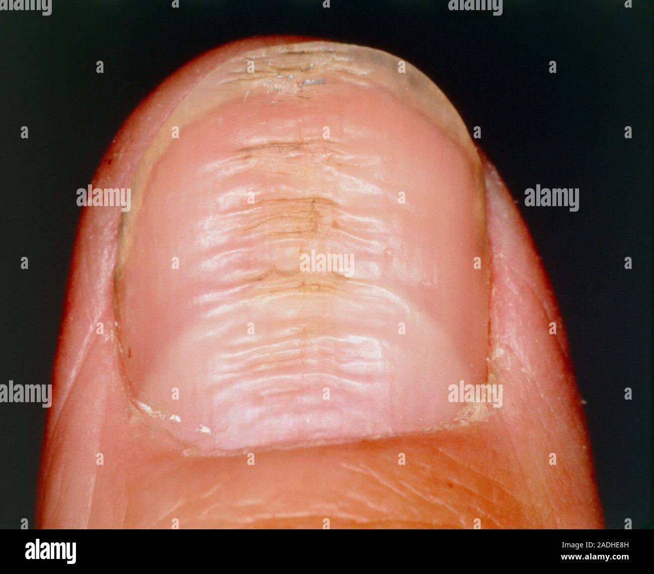 Nail dystrophy. Close-up of horizontal ridges running from the base of ...