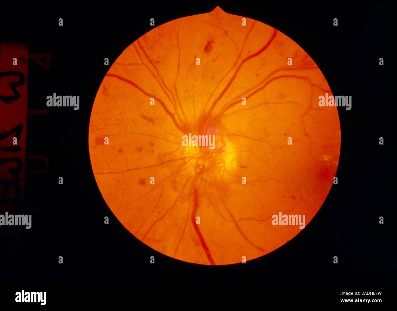 Diabetic retinopathy. Ophthalmoscope view of the retina of the eye in a ...