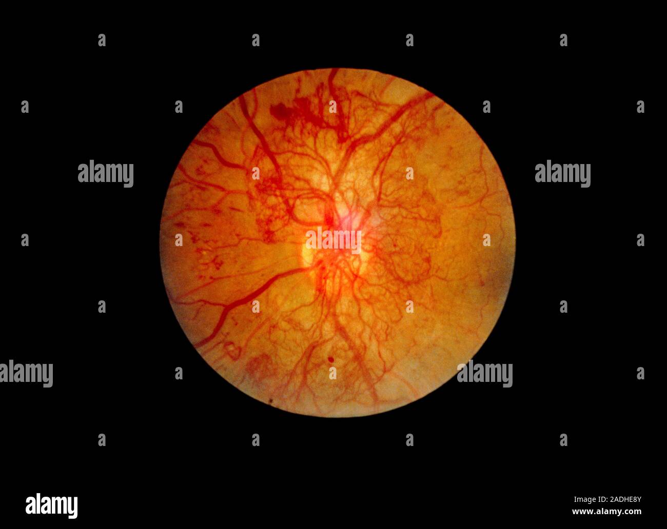 Diabetic retinopathy. Ophthalmoscope view of the retina of the eye in a ...