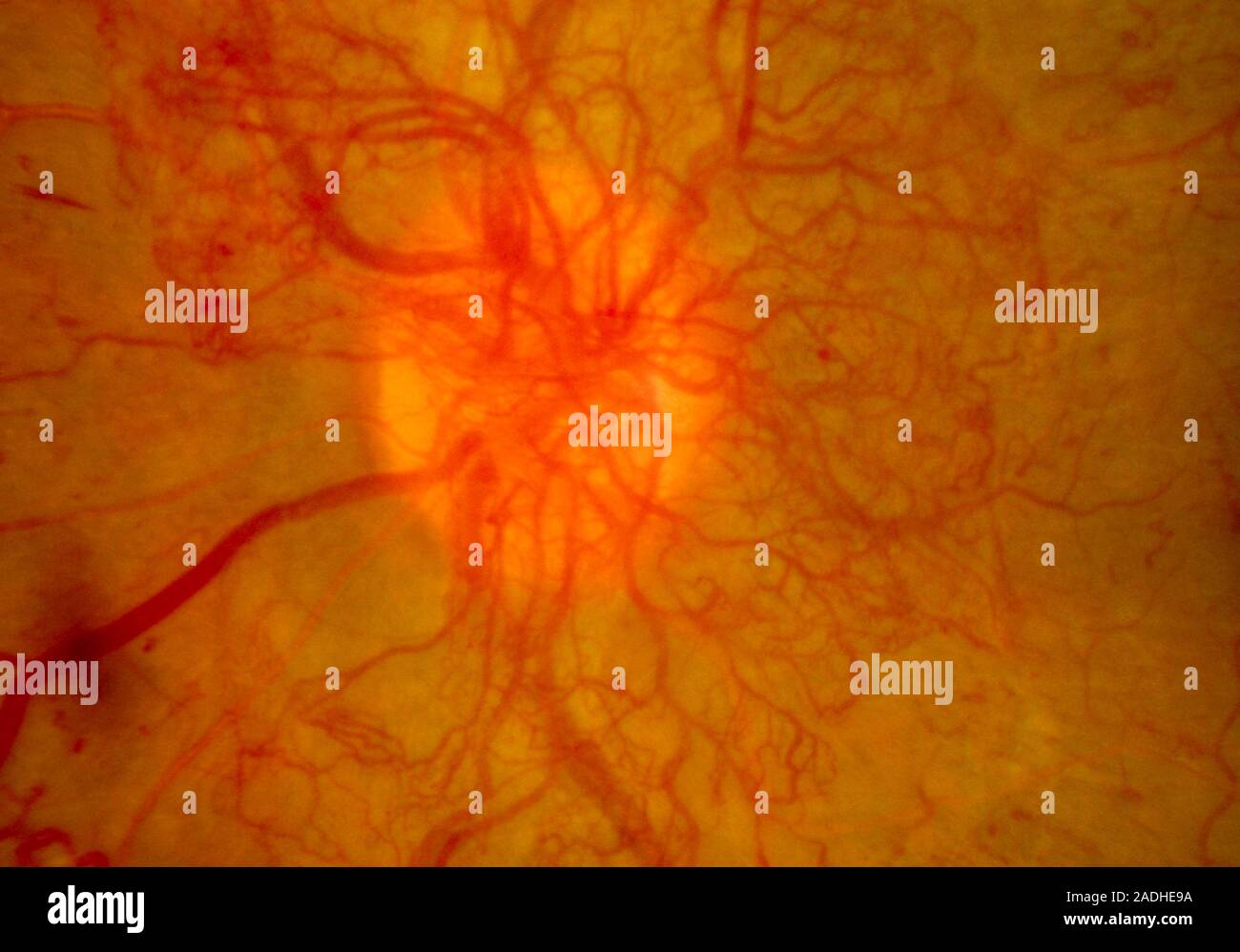 Diabetic retinopathy. Ophthalmoscope view of the retina of the eye in a ...