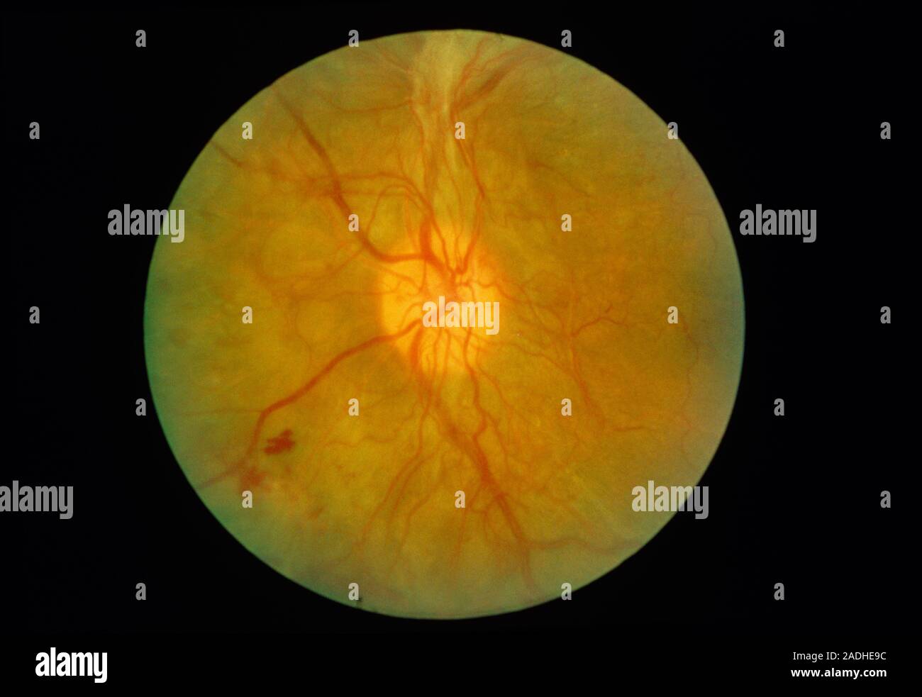 Diabetic retinopathy after laser treatment. Ophthalmoscope view of the ...