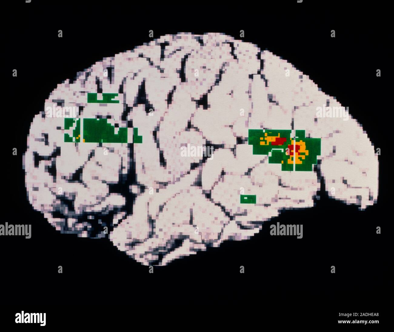 Depression. Coloured Positron Emission Tomography (PET) scan of the ...