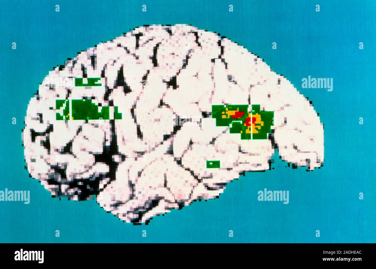 Depression. Coloured Positron Emission Tomography (PET) scan of the ...