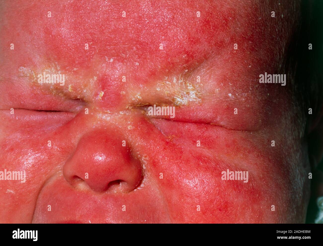 Seborrhoeic dermatitis. Close-up of a red, flaky skin rash (seborrhoeic ...
