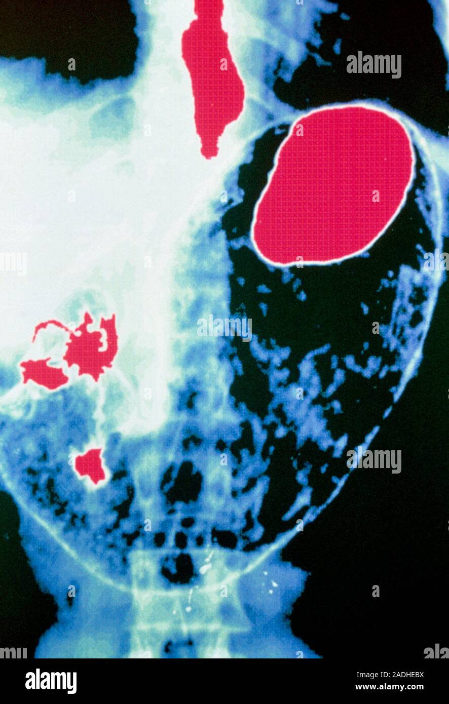Dyspepsia. Coloured X-ray of the human stomach showing gastro ...