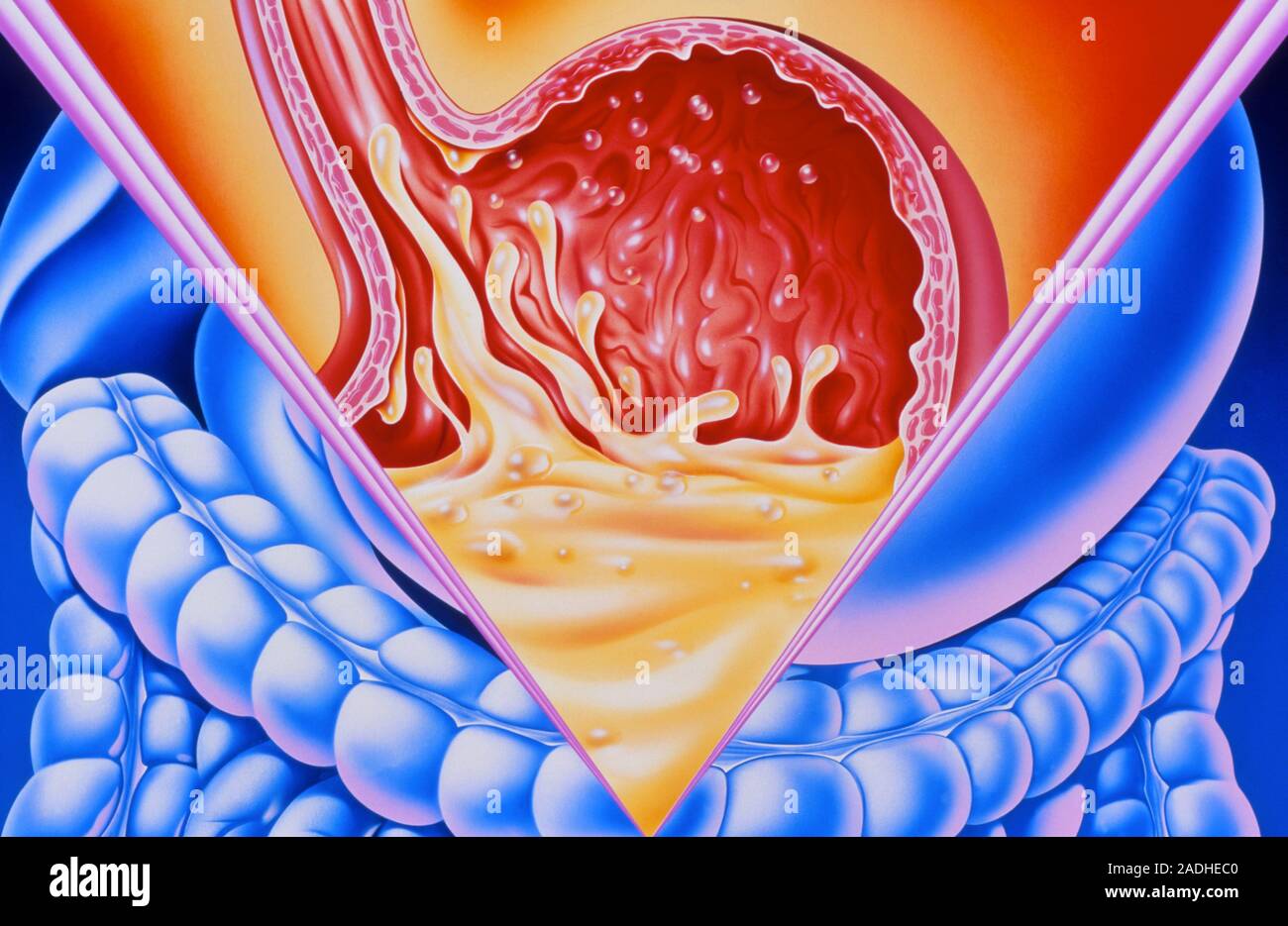 Dyspepsia. Artwork of dyspepsia (indigestion) showing gastro-oesophageal reflux (heartburn) in ...