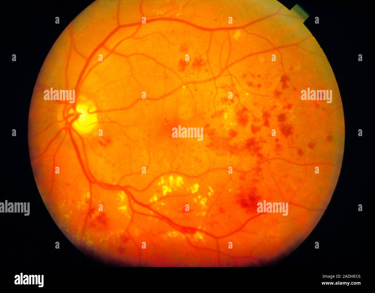 Diabetic Maculopathy Ophthalmoscope View Of The Retina Of A Diabetic Patient Showing Retinal