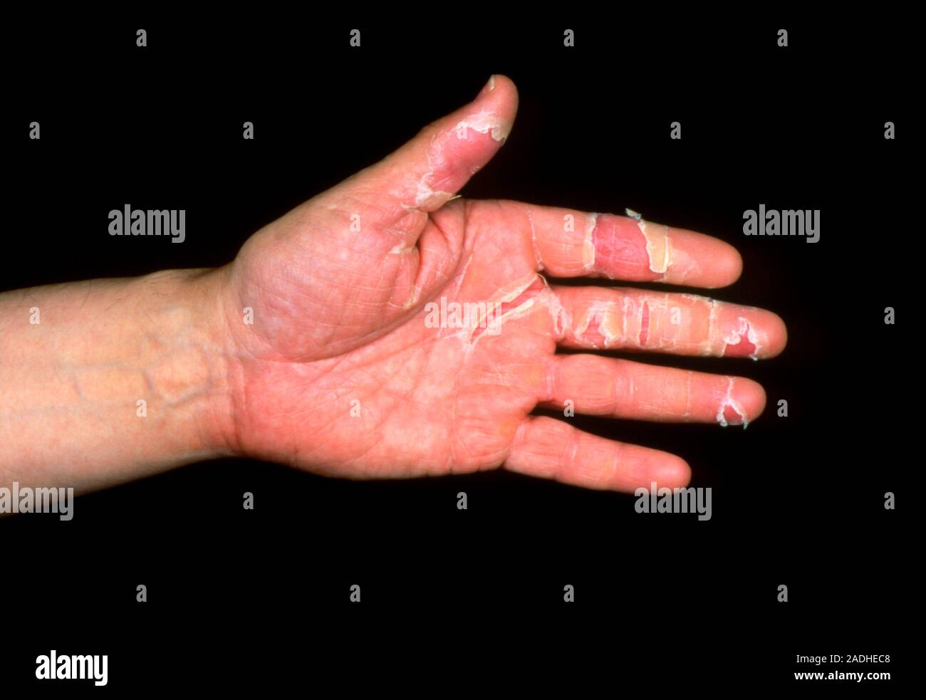 Stress dermatitis. A man's hand showing severe dermatitis with peeling ...