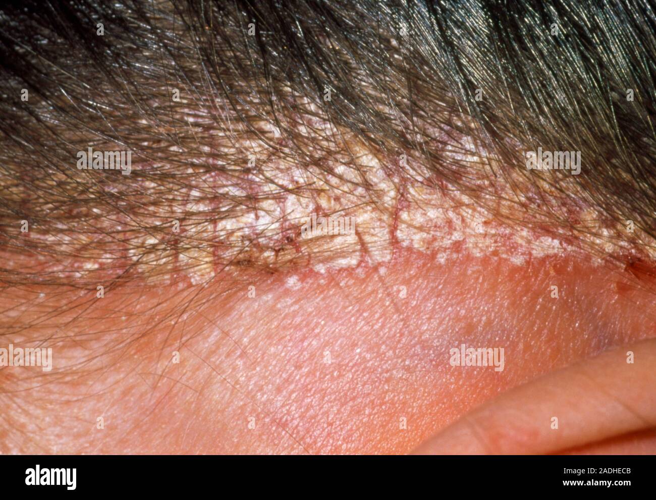 Dandruff. Close-up view of the scalp of a 22 year old woman suffering ...
