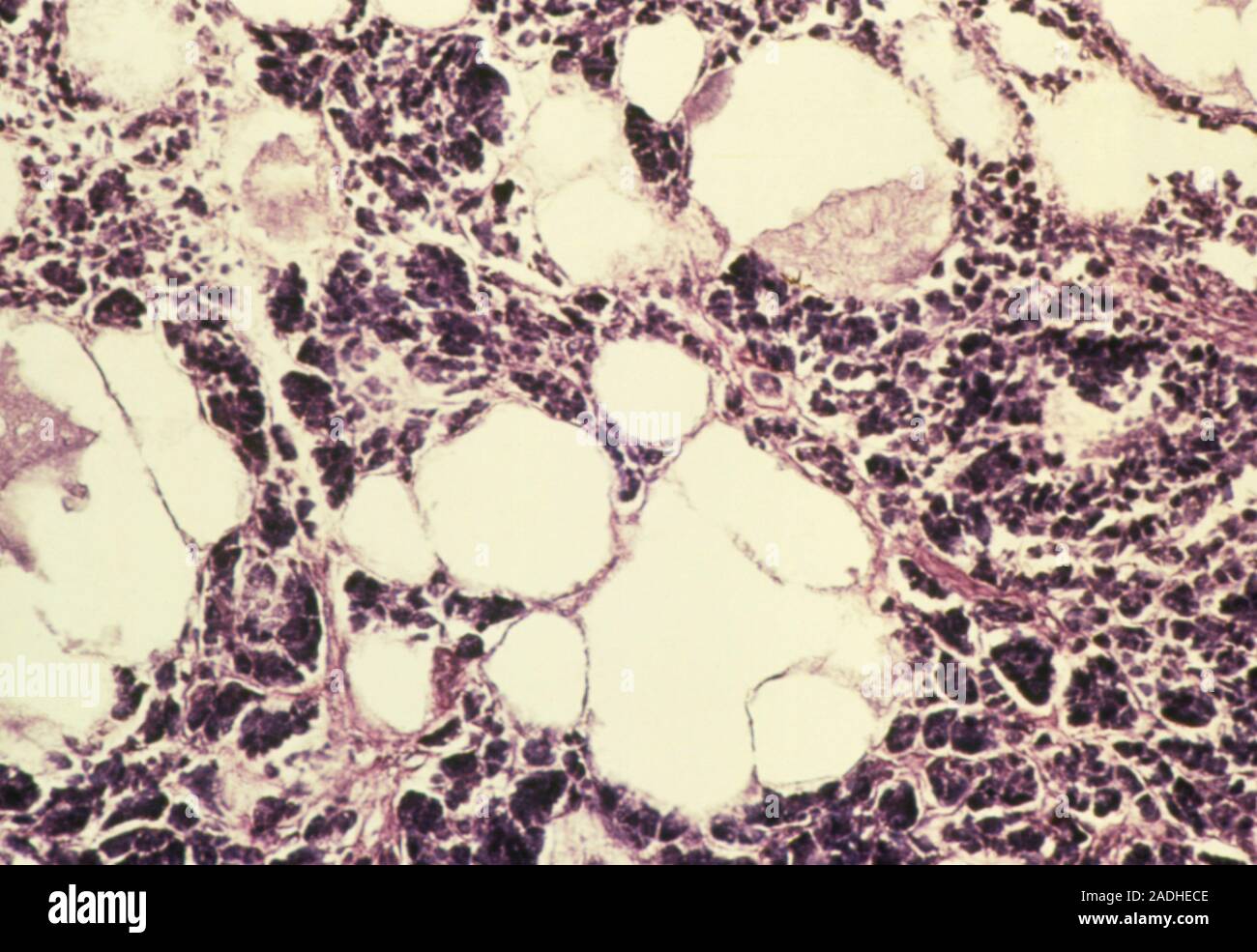 Diabetic pancreas. Light micrograph of a section through the pancreas ...