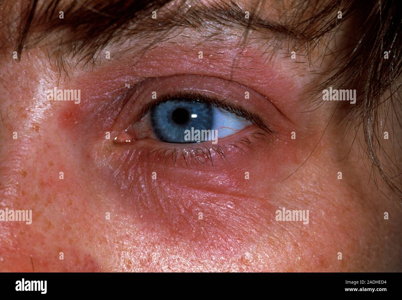 Peri-orbital dermatitis. Sore and inflamed skin around the eye (peri ...