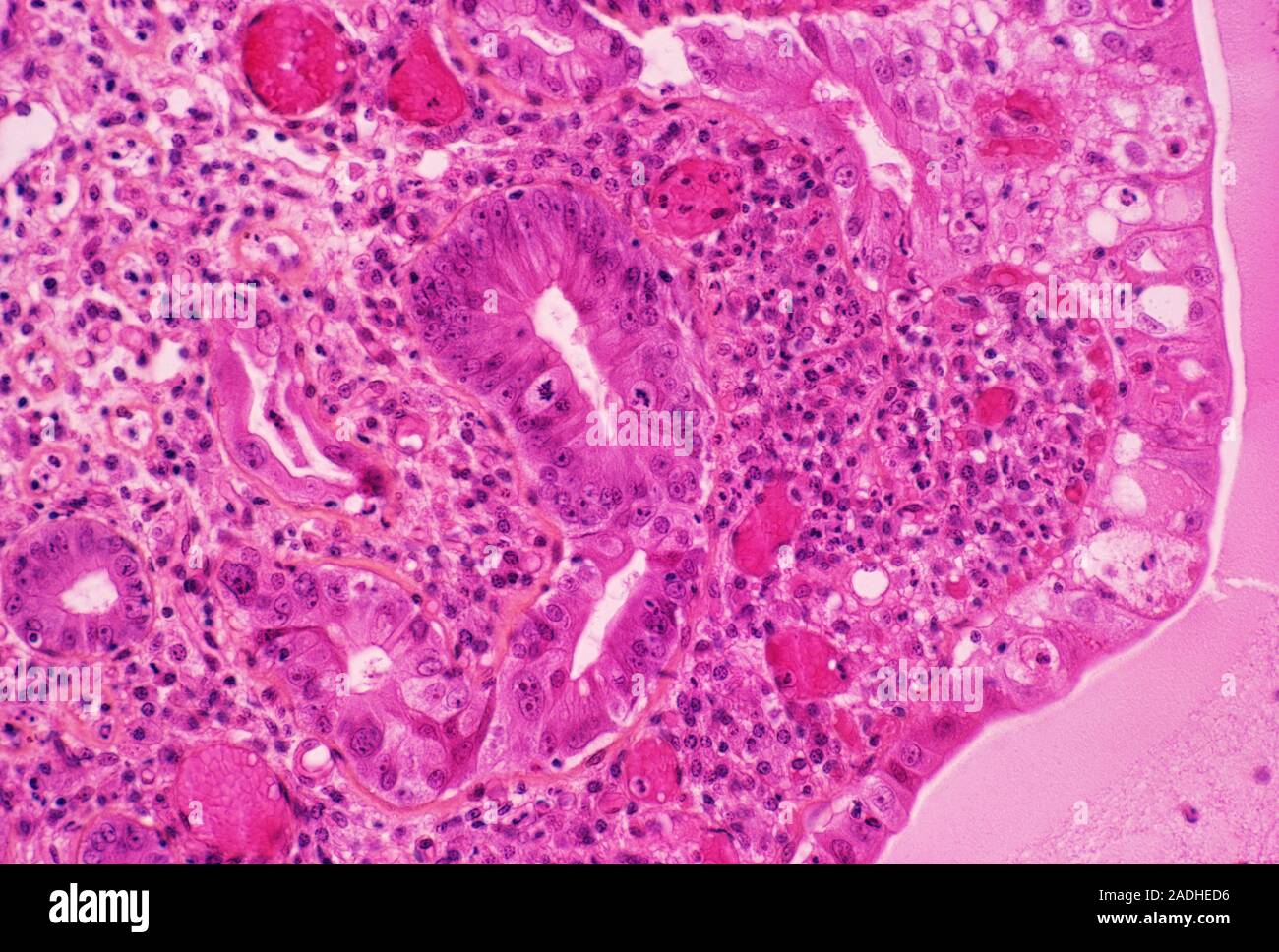 Duodenitis. Light micrograph of pus forming duodenal cells. Duodenitis ...