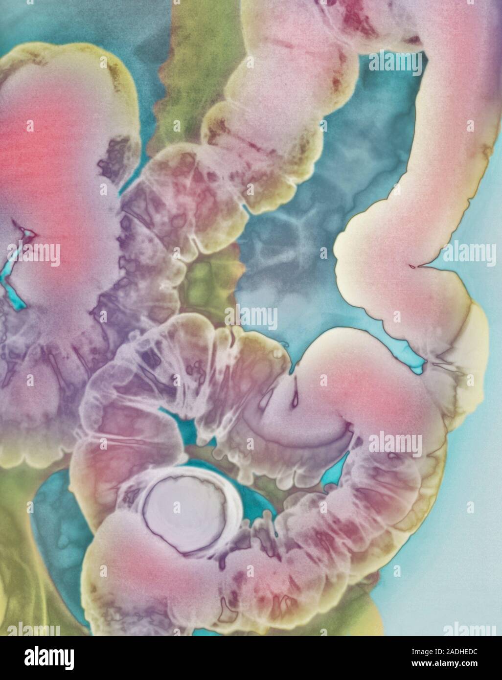 Diverticular disease, coloured X-ray. This illness is also known as ...
