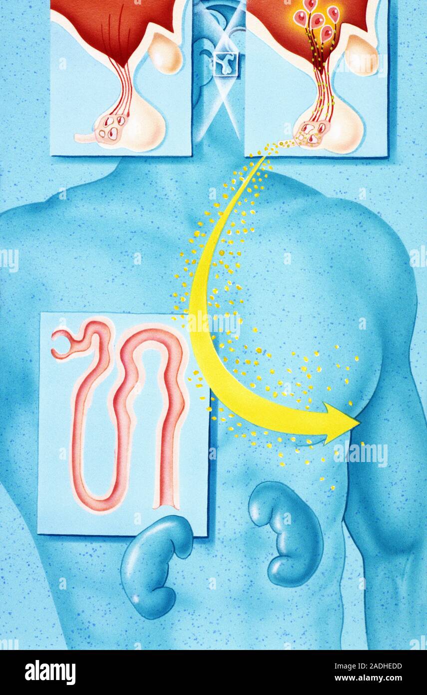 Diabetes insipidus. Artwork of the rare metabolic disorder diabetes ...