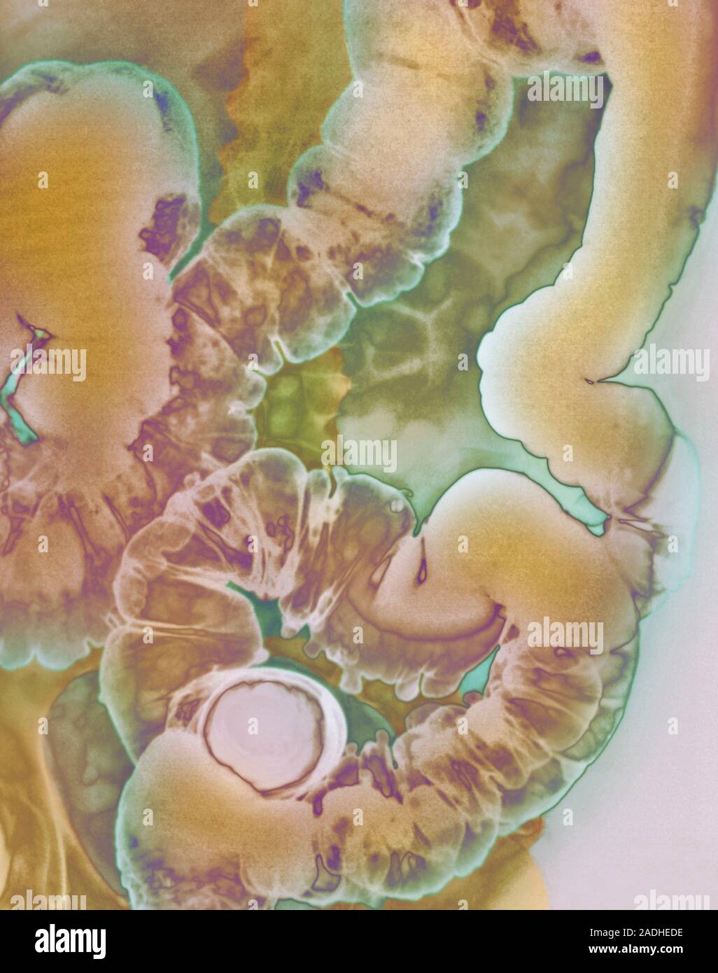 Diverticular disease, coloured X-ray. This illness is also known as ...