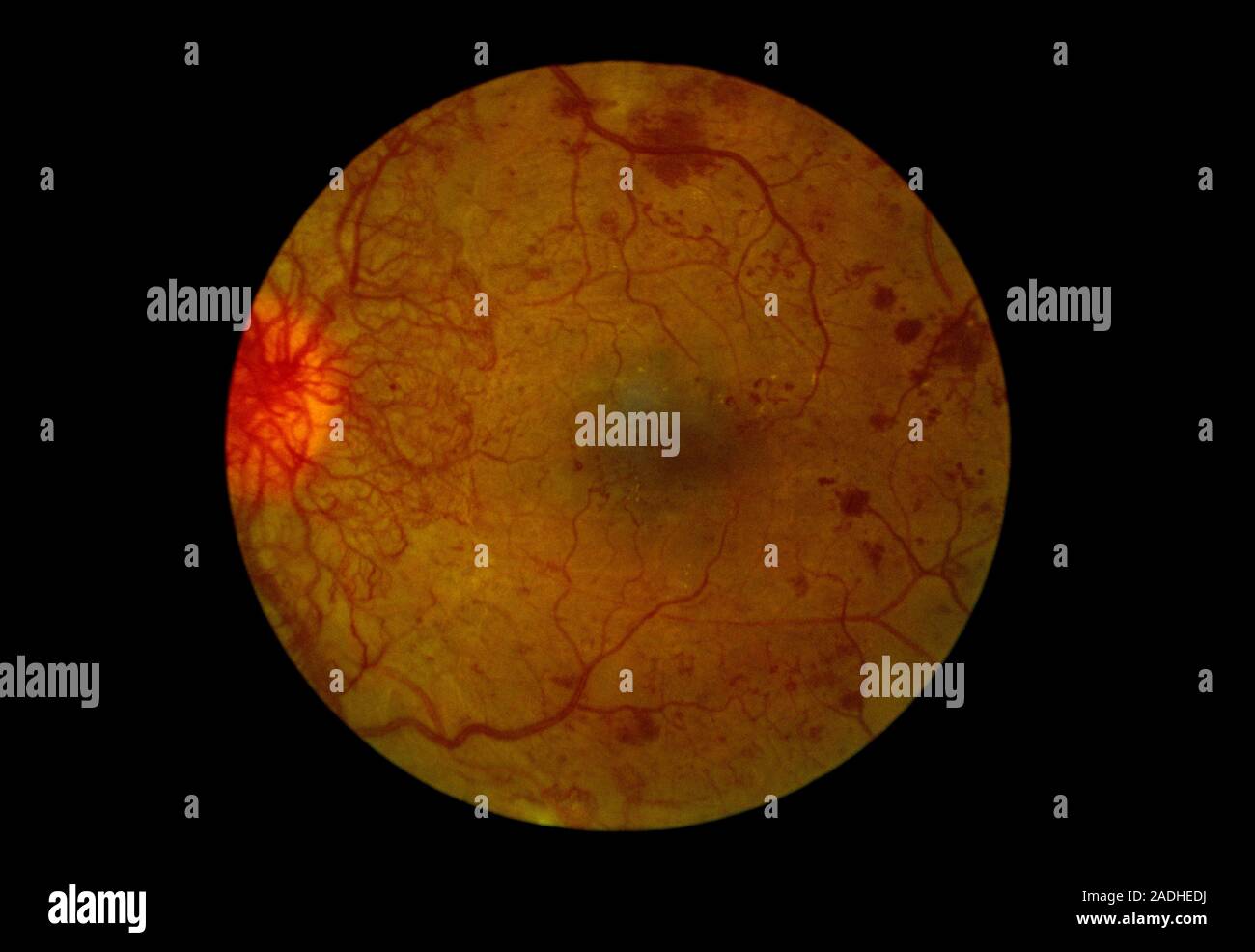 Retinal damage in diabetes. Ophthalmoscope image of diabetic ...