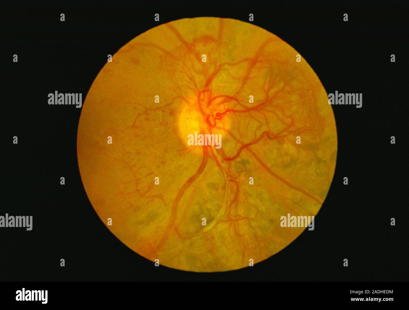 Retinal damage in diabetes. Ophthalmoscope image of diabetic ...