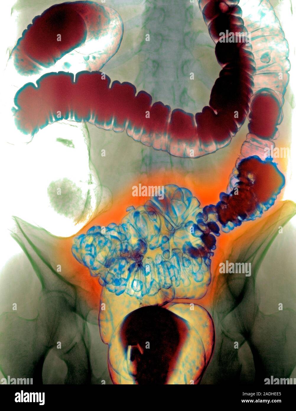 Colon diverticula. Coloured X-ray of part of the abdominal region of a ...