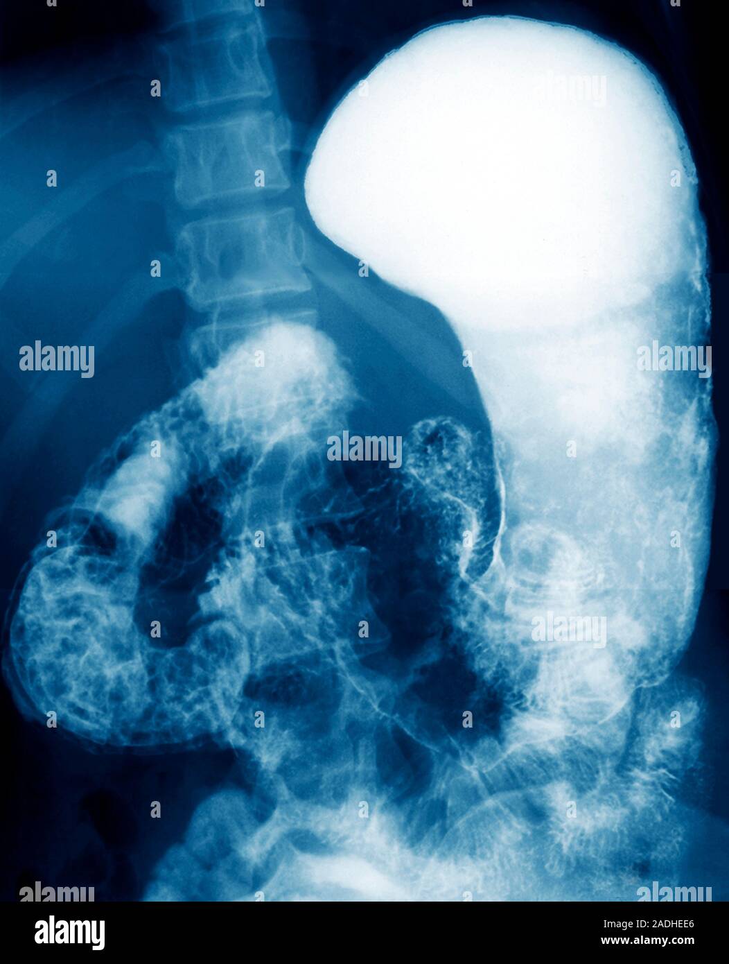 Intestinal disease. X-ray of the duodenum of a 27 year old patient with ...