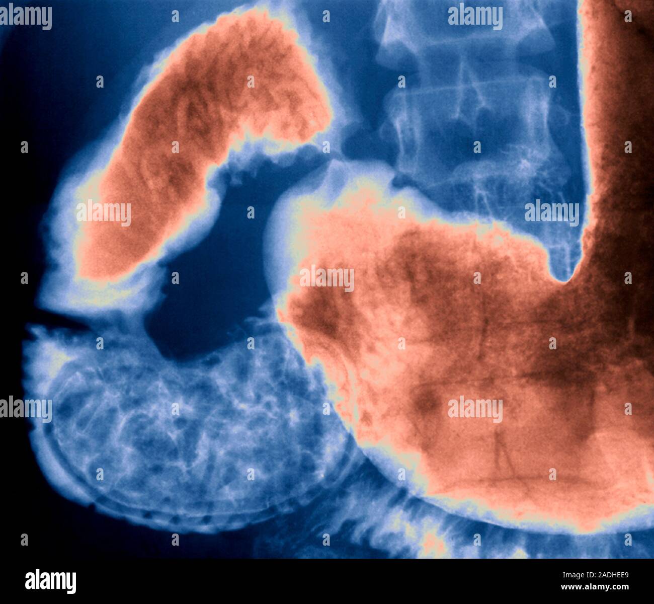 Intestinal disease. Coloured X-ray of the duodenum of a 27 year old ...