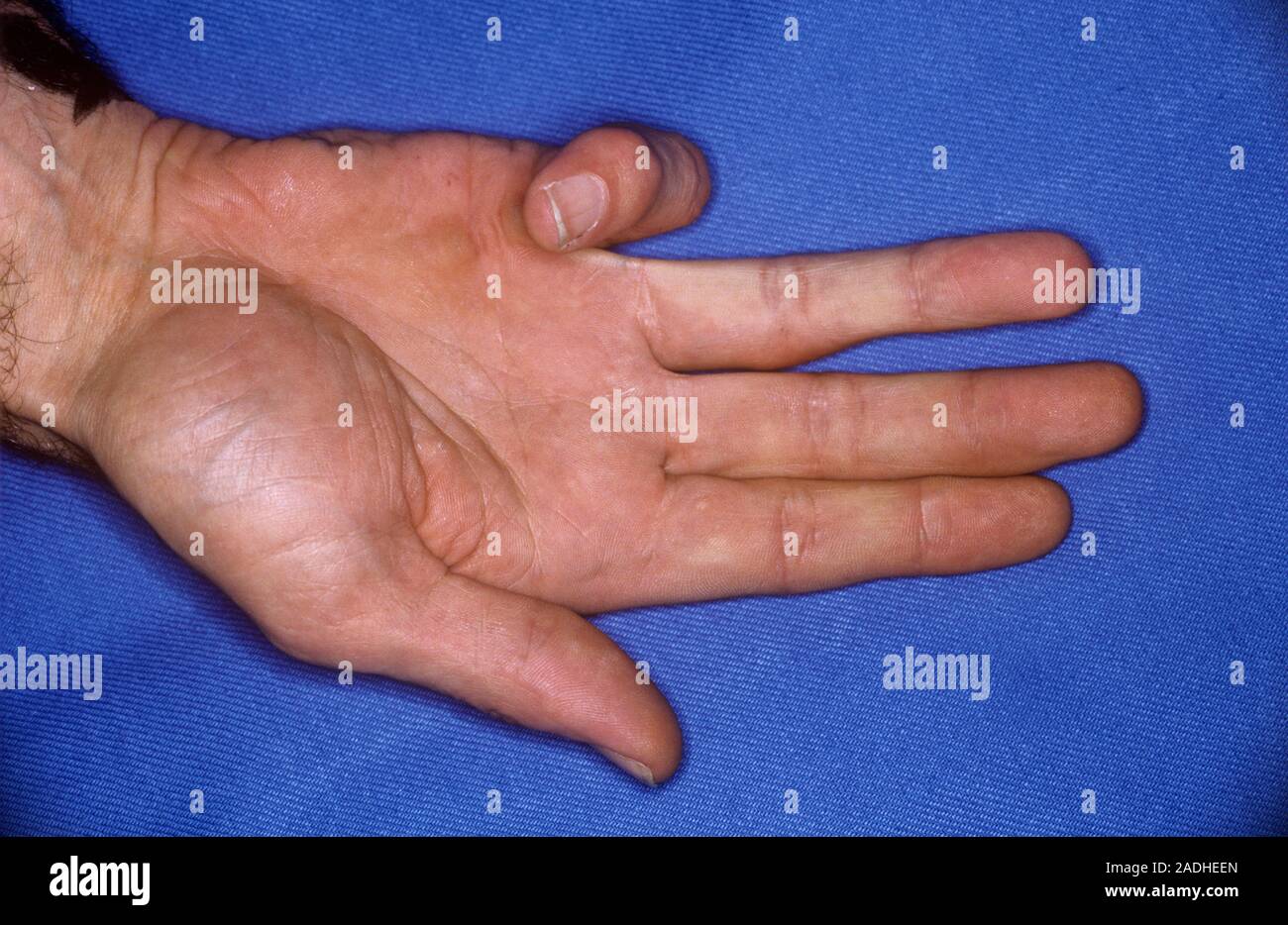 Dupuytren's contracture. Hand of a patient with Dupuytren's contracture ...