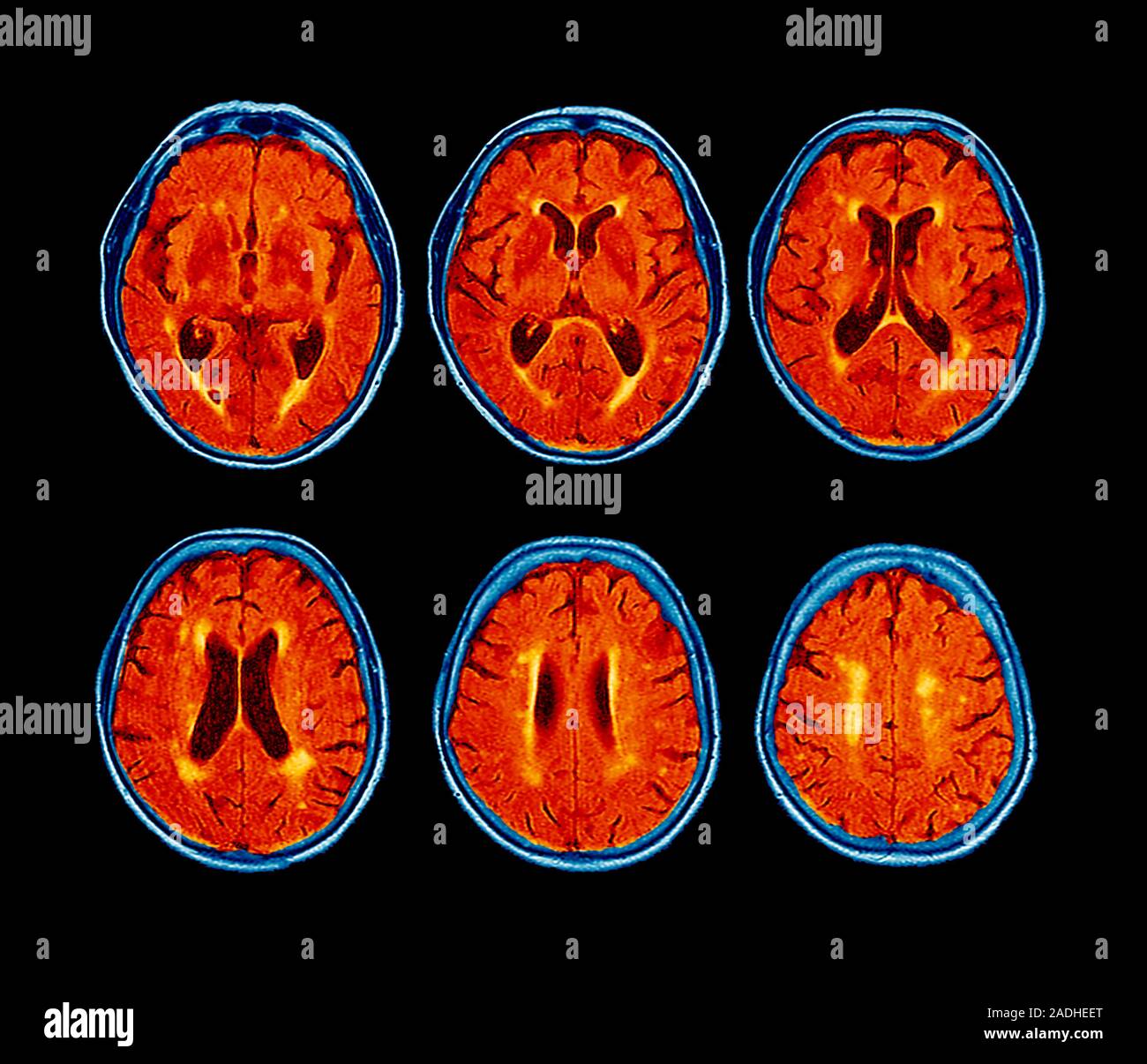 Dementia. Coloured magnetic resonance imaging (MRI) scans of the brain ... Dementia. Coloured magnetic resonance imaging (MRI) scans of the brain ...