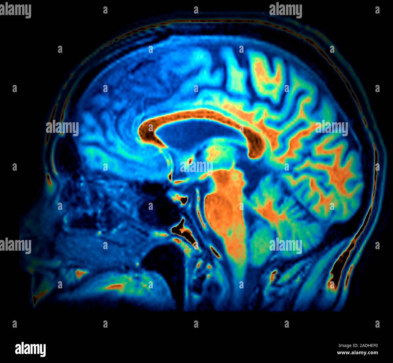 Frontal temporal dementia. Coloured magnetic resonance imaging (MRI ...