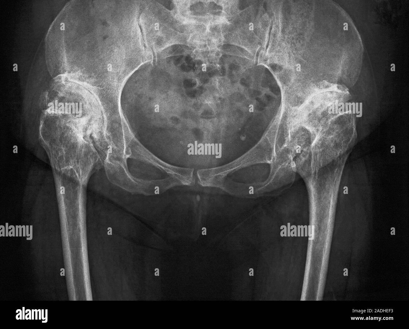Congenital Hip Dysplasia X Ray Of The Hips Of A Woman With Congenital Hip Dysplasia A