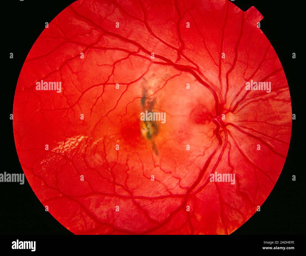 MODEL RELEASED. Retina damage from diabetes. Ophthalmoscope image of ...