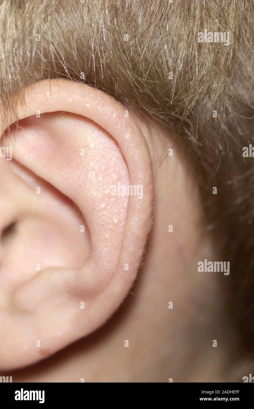 Juvenile spring eruption (pale bumps) on an 8 year old boy's ear. This ...