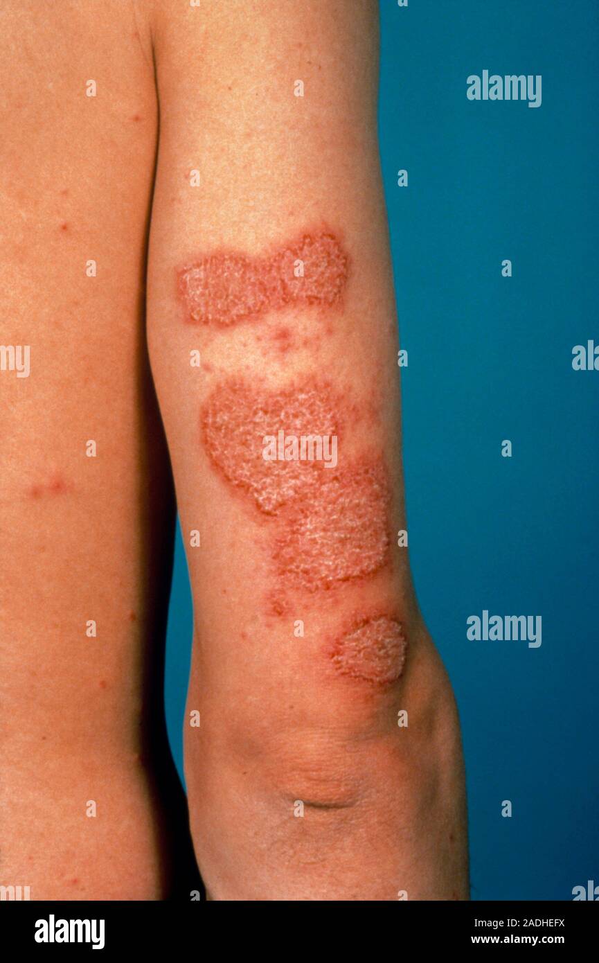 Discoid eczema affecting the upper arm. Eczema is a general term used ...