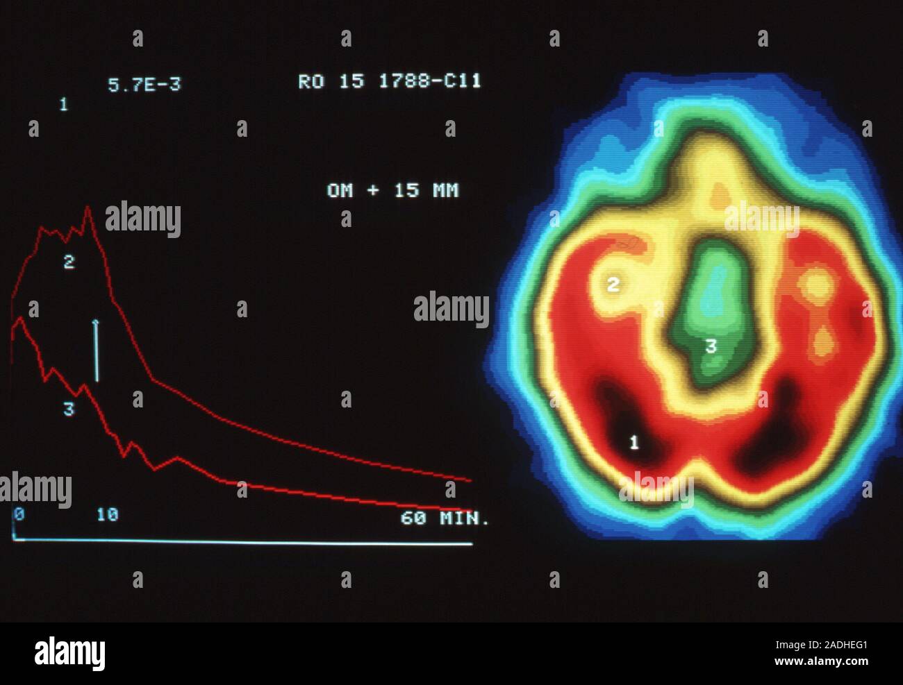 Positron emission tomography (PET) scan of the brain of a person who ...