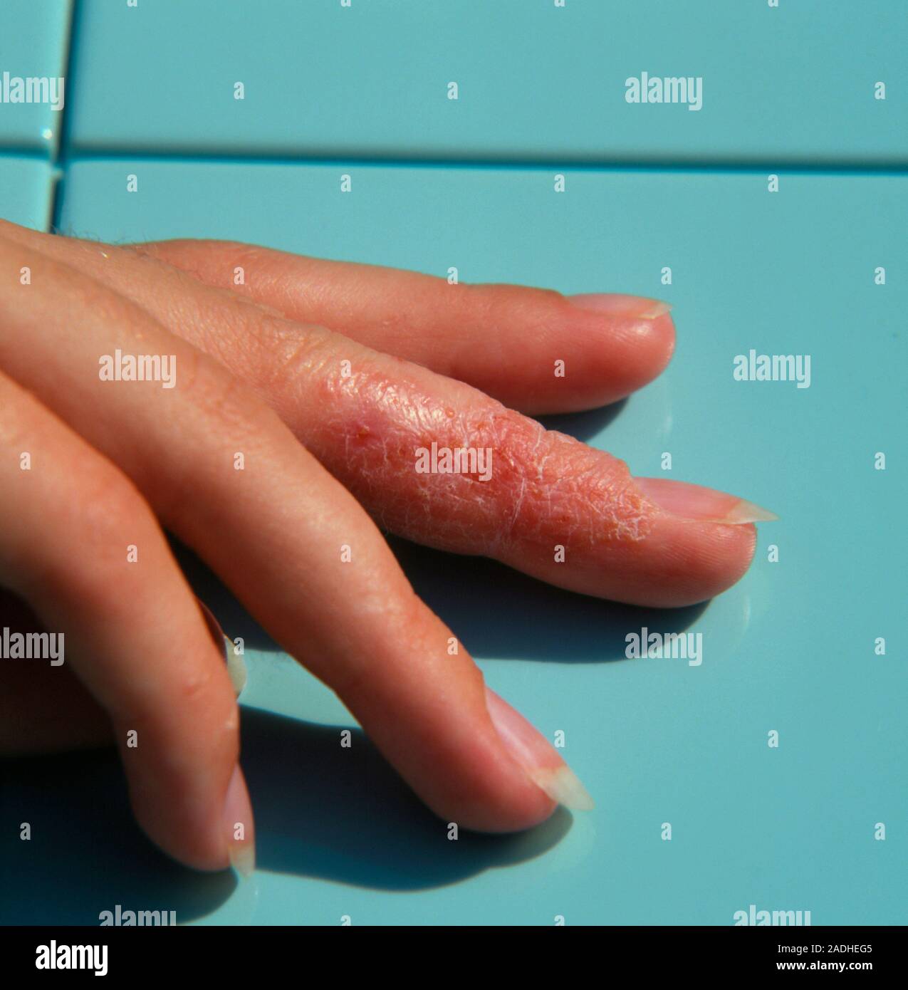 Close-up of eczema affecting a woman's finger. Eczema is a superficial ...