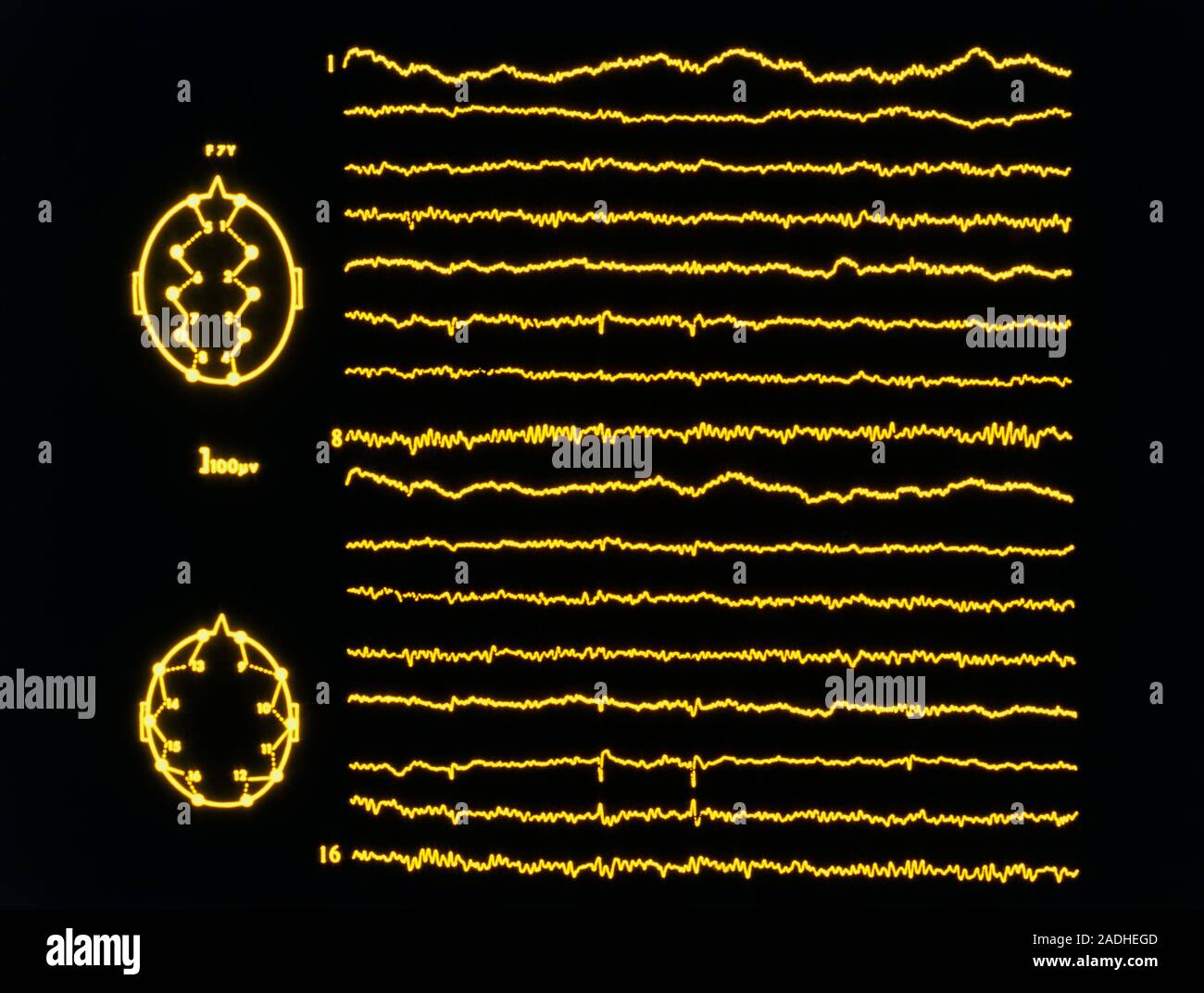 Focal Epilepsy False Colour Electroencephalogram Eeg Showing Focal Epileptic Spikes Over The