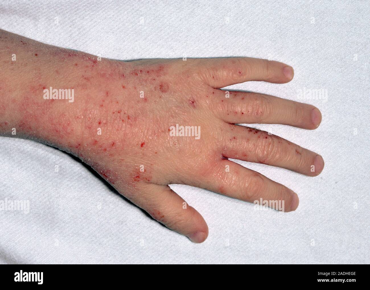 Atopic Eczema On Hands